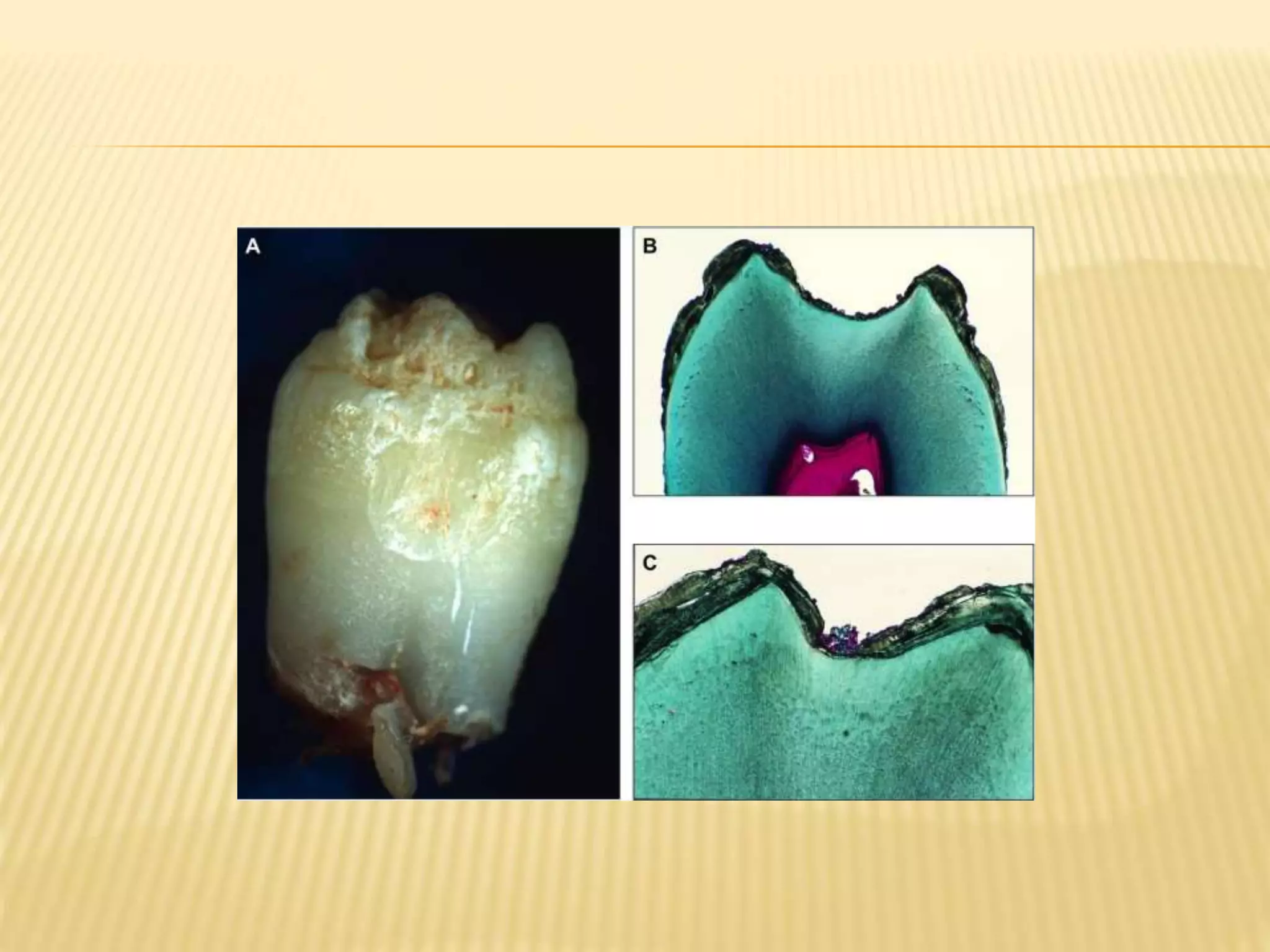 Enamel defects | PPTX