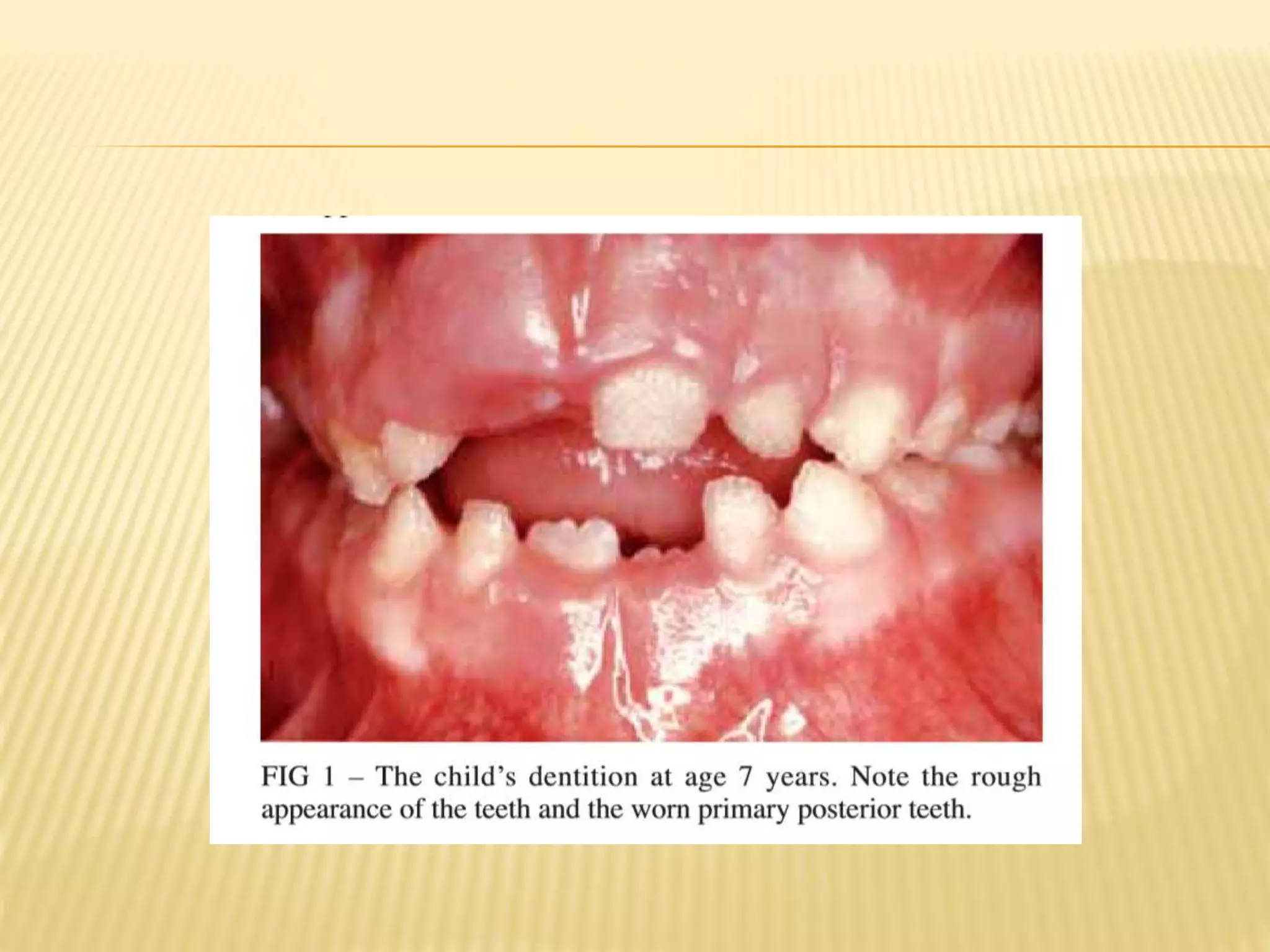 Enamel defects | PPTX