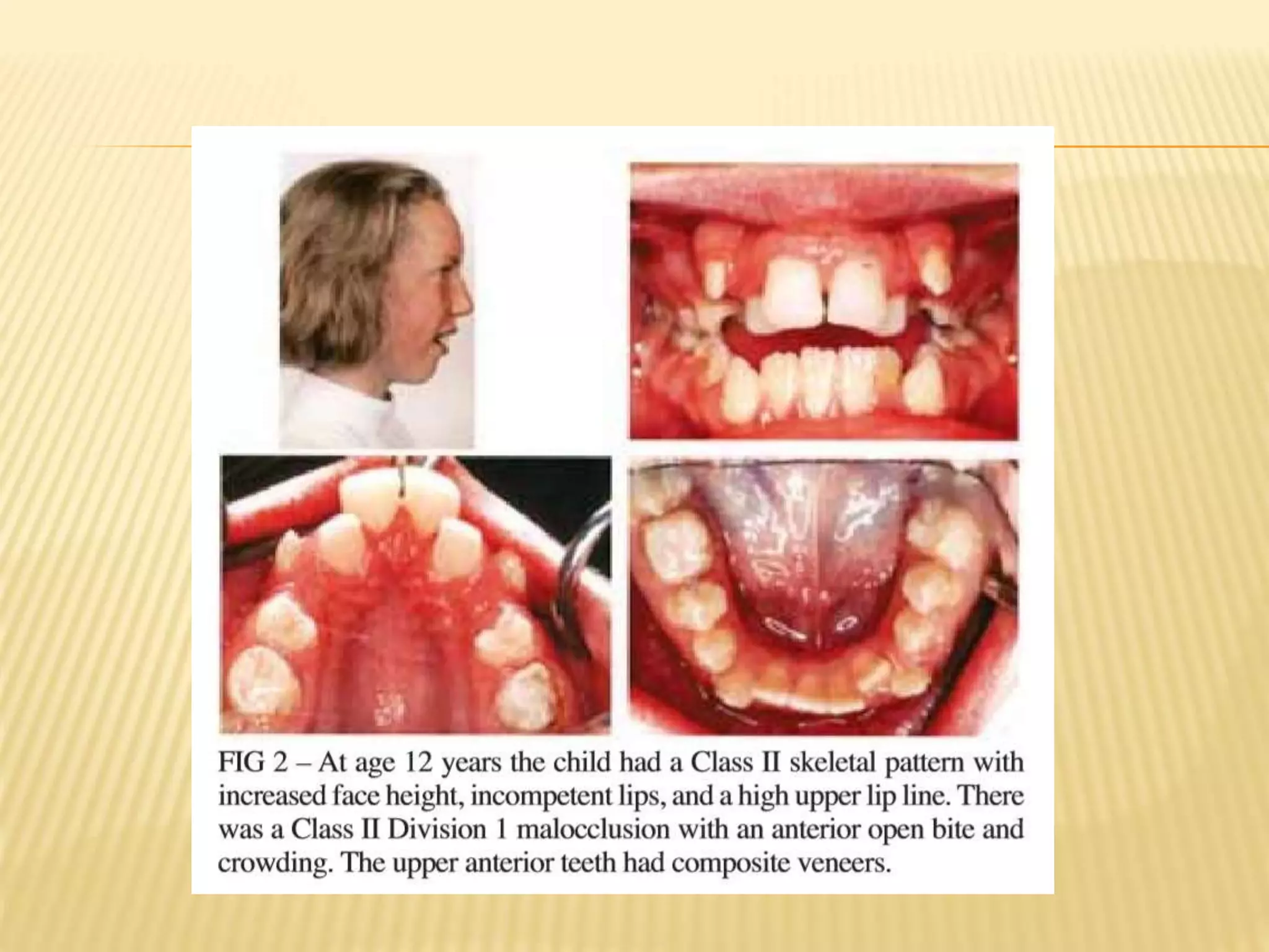Enamel defects | PPTX