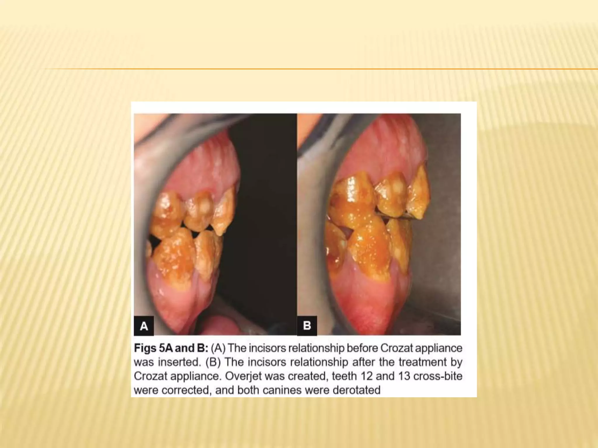 Enamel defects | PPTX