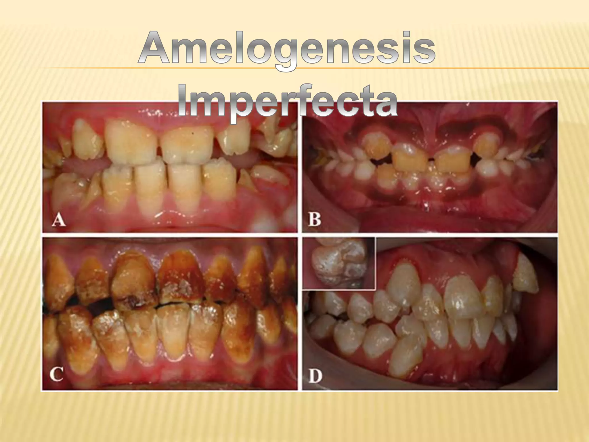 Enamel defects | PPTX