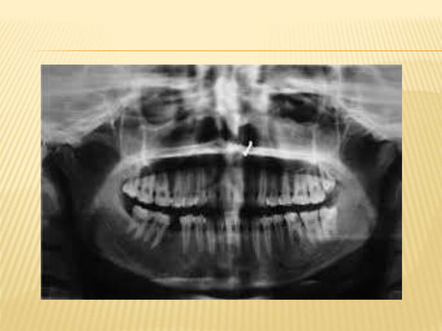 Enamel defects | PPTX | Dental Health | Diseases and Conditions