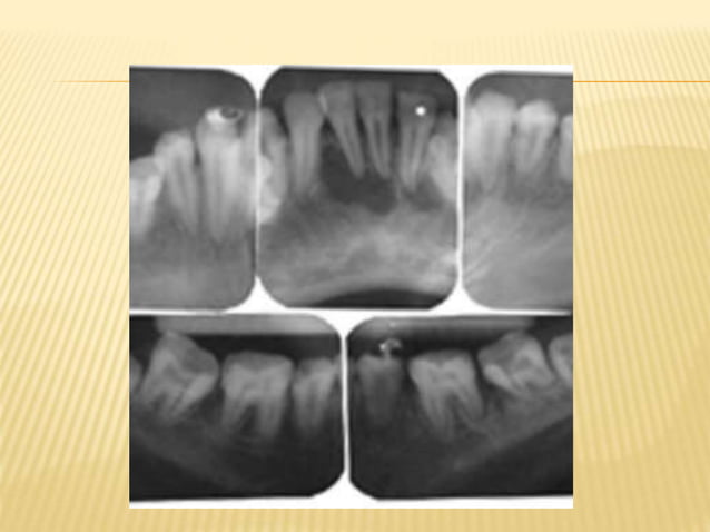 Enamel defects | PPTX | Dental Health | Diseases and Conditions