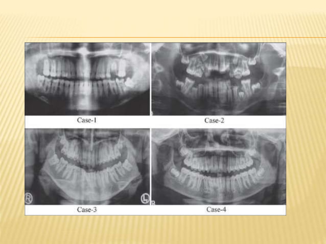 Enamel defects | PPTX | Dental Health | Diseases and Conditions
