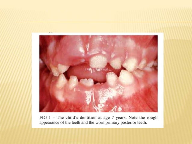 Enamel defects | PPTX | Dental Health | Diseases and Conditions