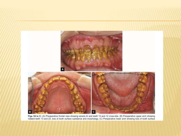 Enamel defects | PPTX | Dental Health | Diseases and Conditions