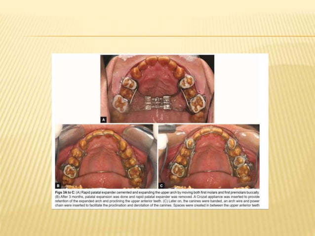 Enamel defects | PPTX | Dental Health | Diseases and Conditions