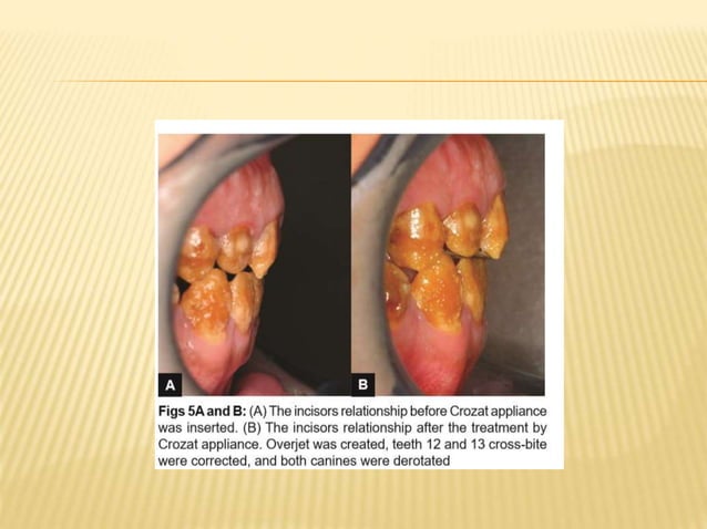 Enamel defects | PPTX | Dental Health | Diseases and Conditions