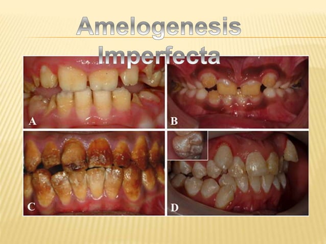 Enamel defects | PPTX | Dental Health | Diseases and Conditions