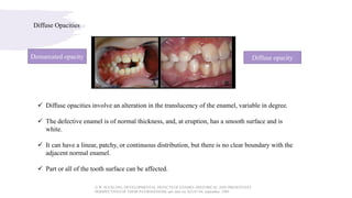 Enamel defects | PDF
