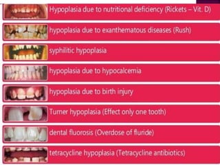 Enamel Hypocalcification Vs Enamel Hypoplasia