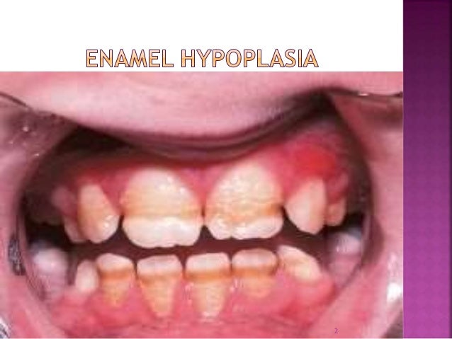 Enamel hypoplasia ppt Enamel hypoplasia ppt