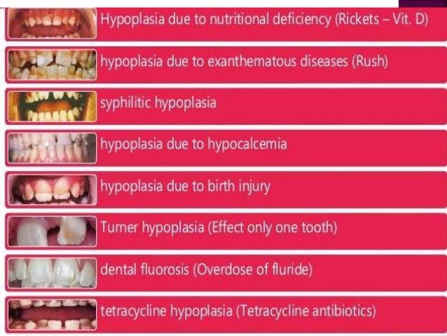 Enamel hypoplasia ppt