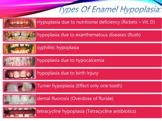 Enamel hypoplasia | PPTX