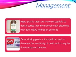 Enamel hypoplasia | PPTX