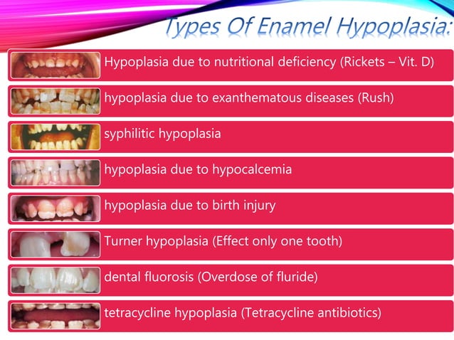 Enamel hypoplasia