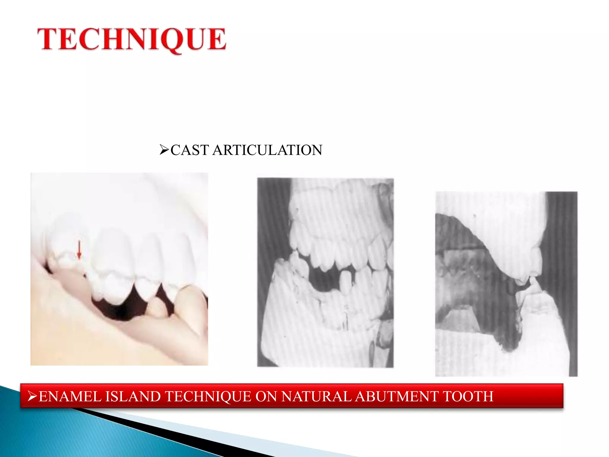 Enamel island technique | PPTX