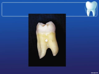 Enamel pearl | PPTX