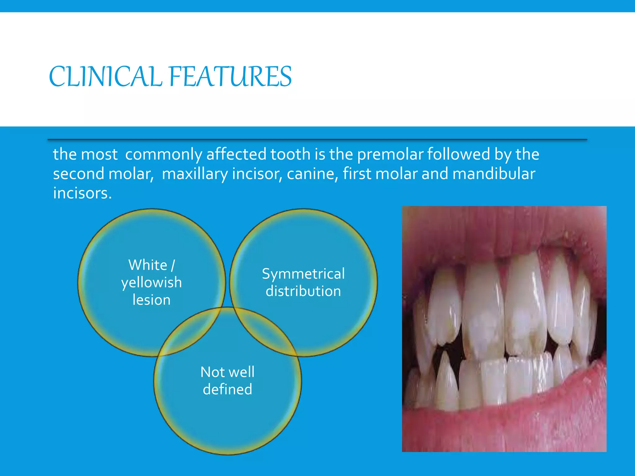 Enamel white lesions | PPTX