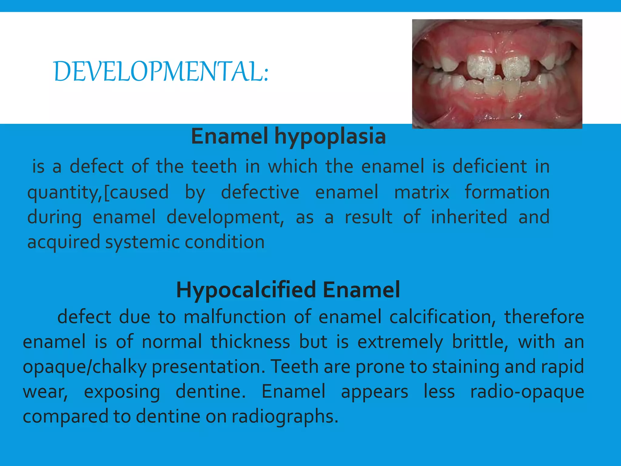 Enamel white lesions | PPTX