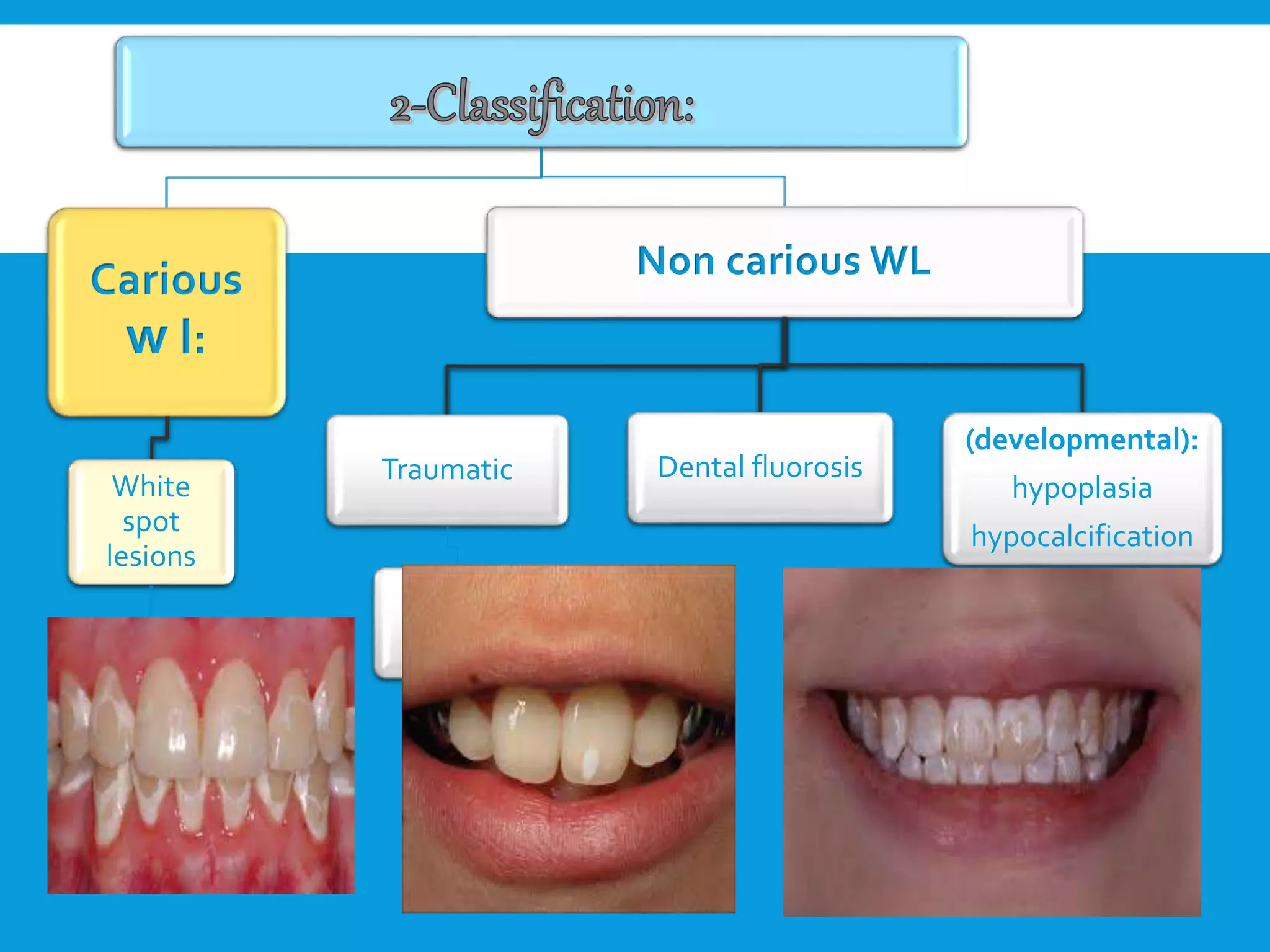Enamel white lesions | PPTX