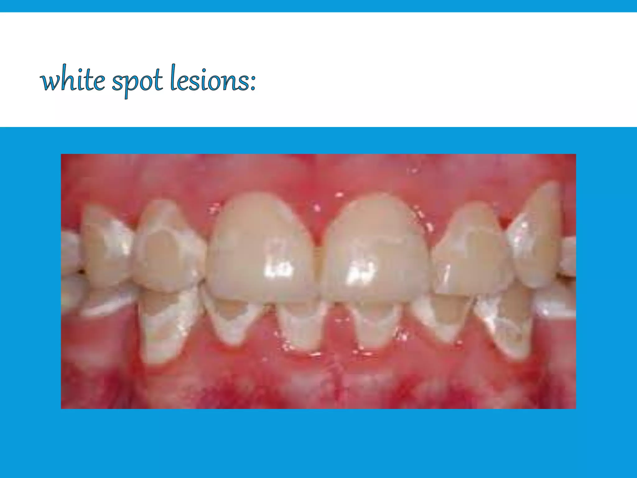 Enamel white lesions | PPTX