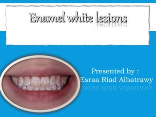 Enamel white lesions | PPTX