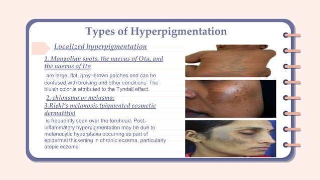 Skin pigmentation | PPTX