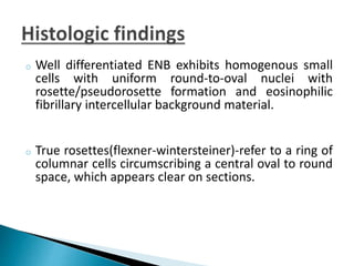 Esthesioneuroblastoma (ENB) | PPTX