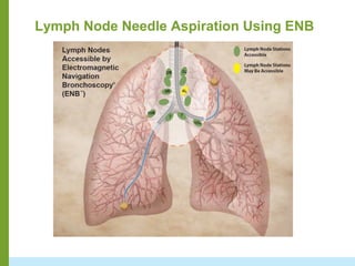 Electromagnetic Navigation Bronchoscopy (ENB): Clinical Review | PPT