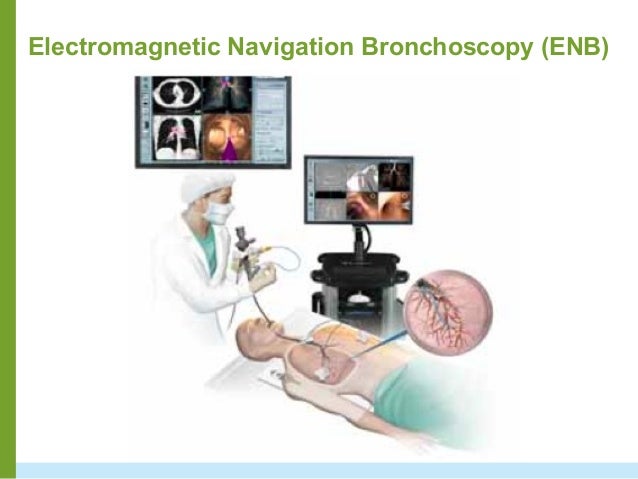 Electromagnetic Navigation Bronchoscopy (ENB): Clinical Review