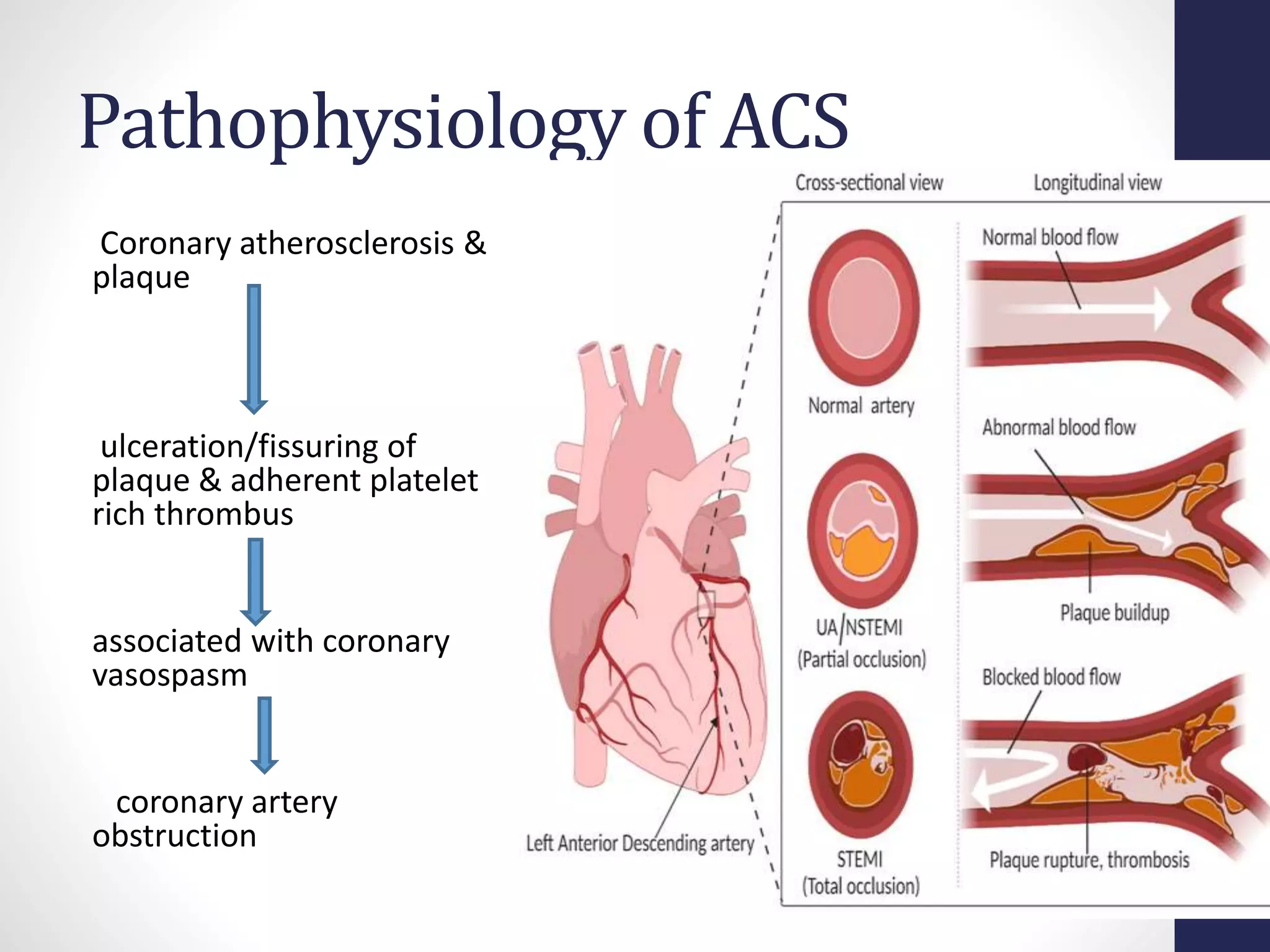 Acute coronary syndrome | PPTX