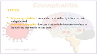 encephaliitis ( UNIT - VI ), AHN - II.pptx
