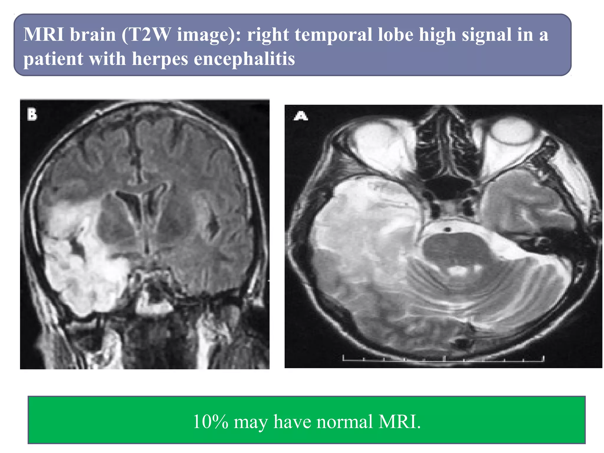Encephalitis | PPT