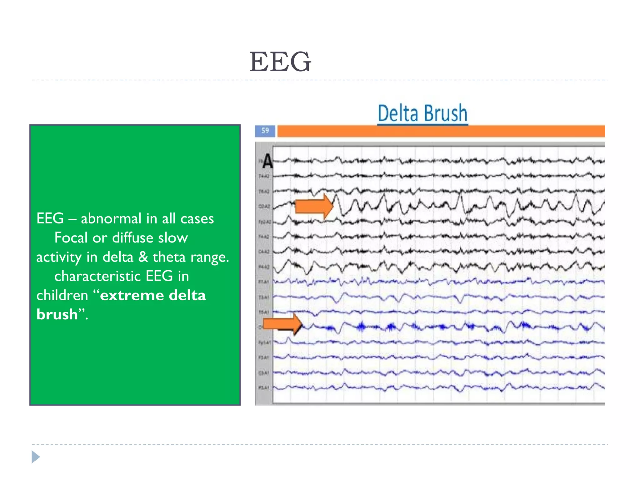 Encephalitis | PPT