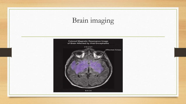 Encephalitis | PPTX | Physical Therapy | Wellness