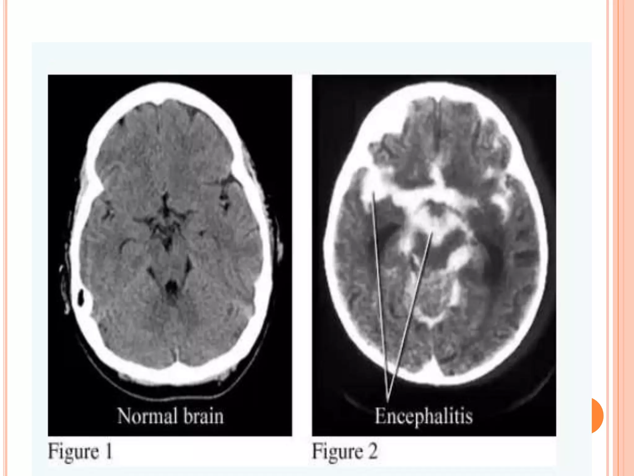 Encephalitis & Nursing care | PPTX