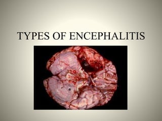 Encephalitis | PPTX