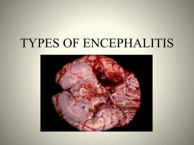 Encephalitis | PPTX