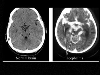 Encephalitis explanation | PPTX
