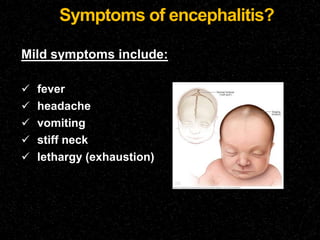 Encephalitis explanation | PPTX