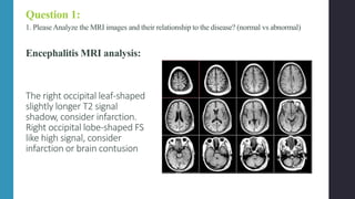Encephalitis, analyzing MRI and treatment of intractable epilepsy | PPT