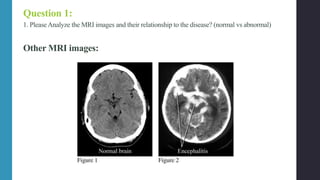Encephalitis, analyzing MRI and treatment of intractable epilepsy | PDF