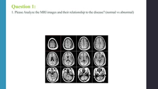 Encephalitis, analyzing MRI and treatment of intractable epilepsy | PDF