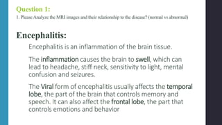 Encephalitis, analyzing MRI and treatment of intractable epilepsy | PDF