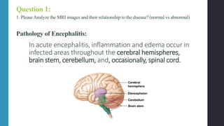 Encephalitis, analyzing MRI and treatment of intractable epilepsy | PPT