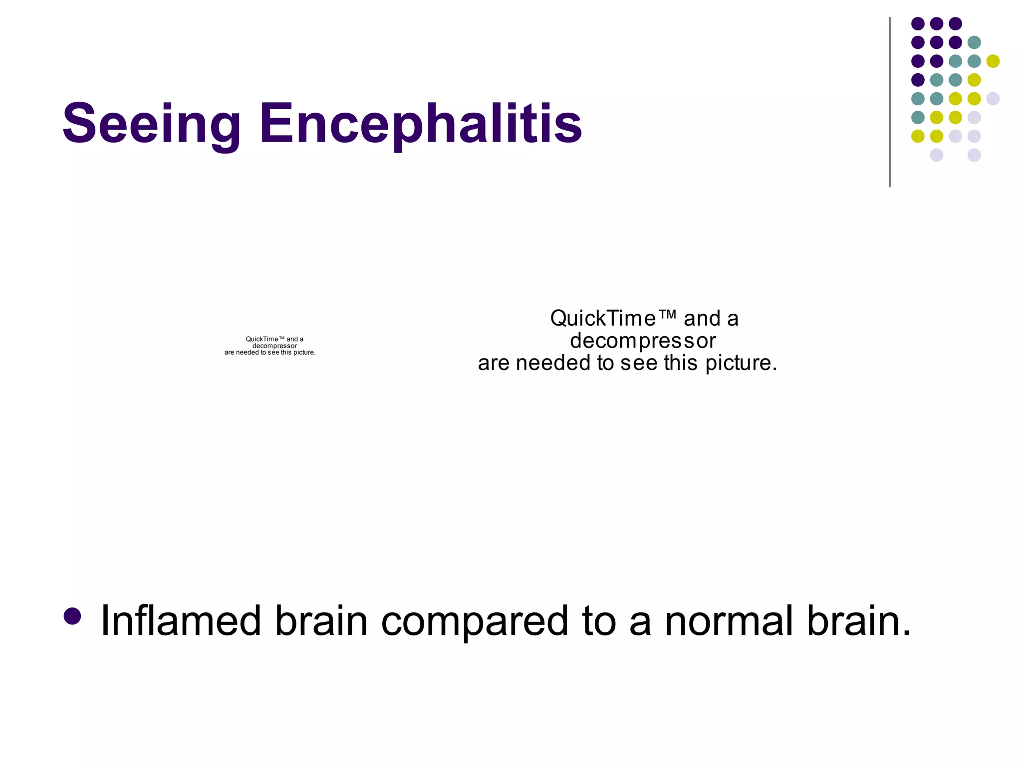 Encephalitis ppt | PPT