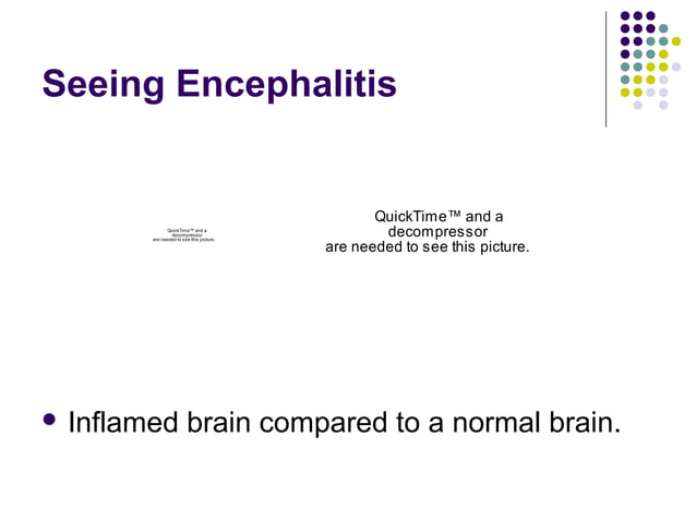 Encephalitis ppt | PPT | Free Download