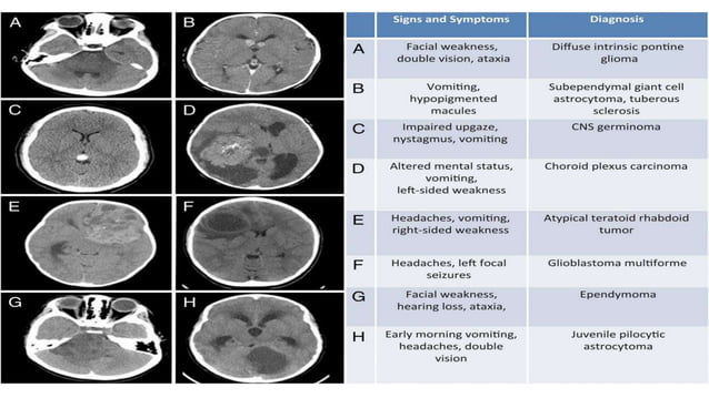 ENCEPHALOPATHY | PPTX | Digestive Disorders | Diseases and Conditions