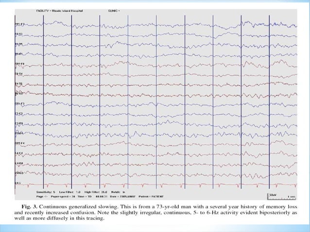 Encephalopathy with EEG based Grading | PPT | Brain and Nervous System ...